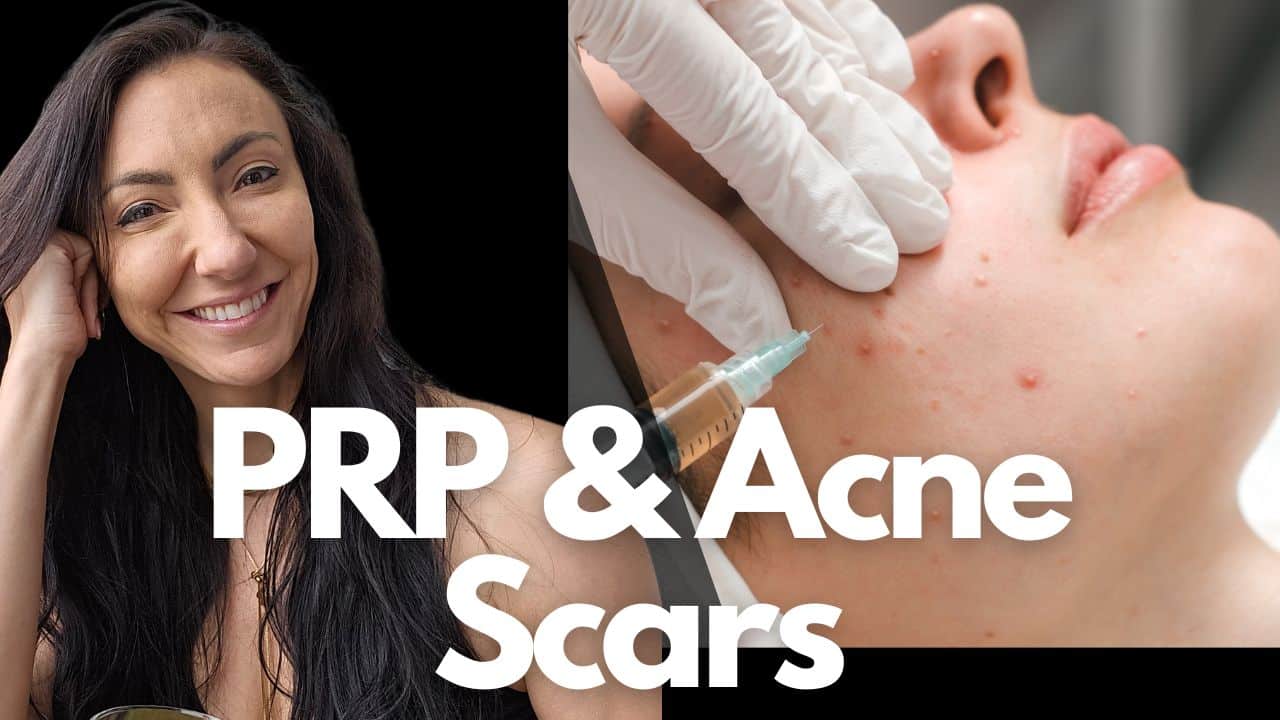 PRP For Acne Scars | Sparkle Lifestyle & Medispa